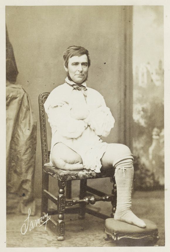 Bonhams : GAMGEE (JOHN SAMPSON) History of a Successful Case of ...